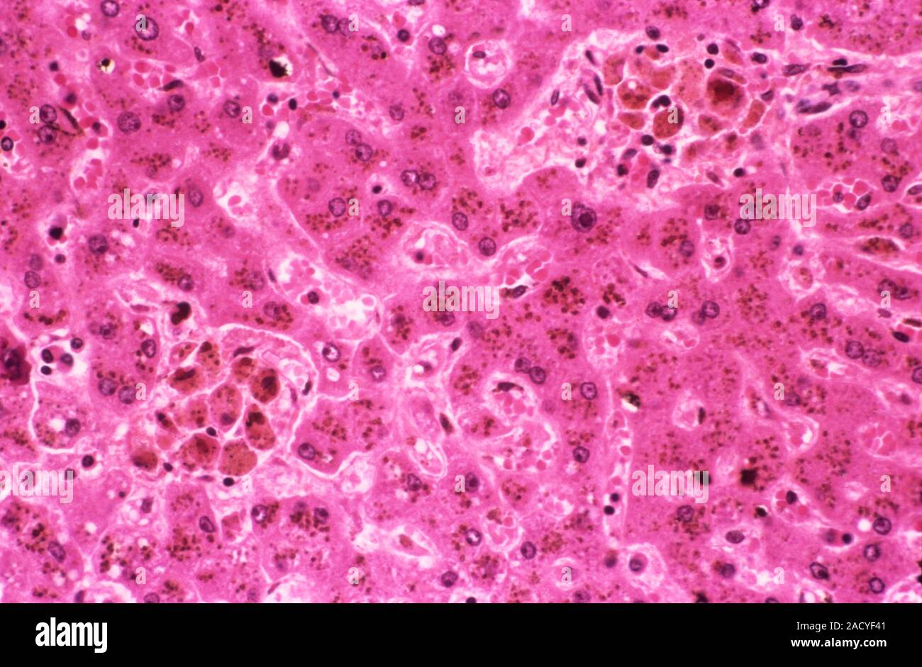 Siderosis in the liver. Light micrograph of a section through a liver ...