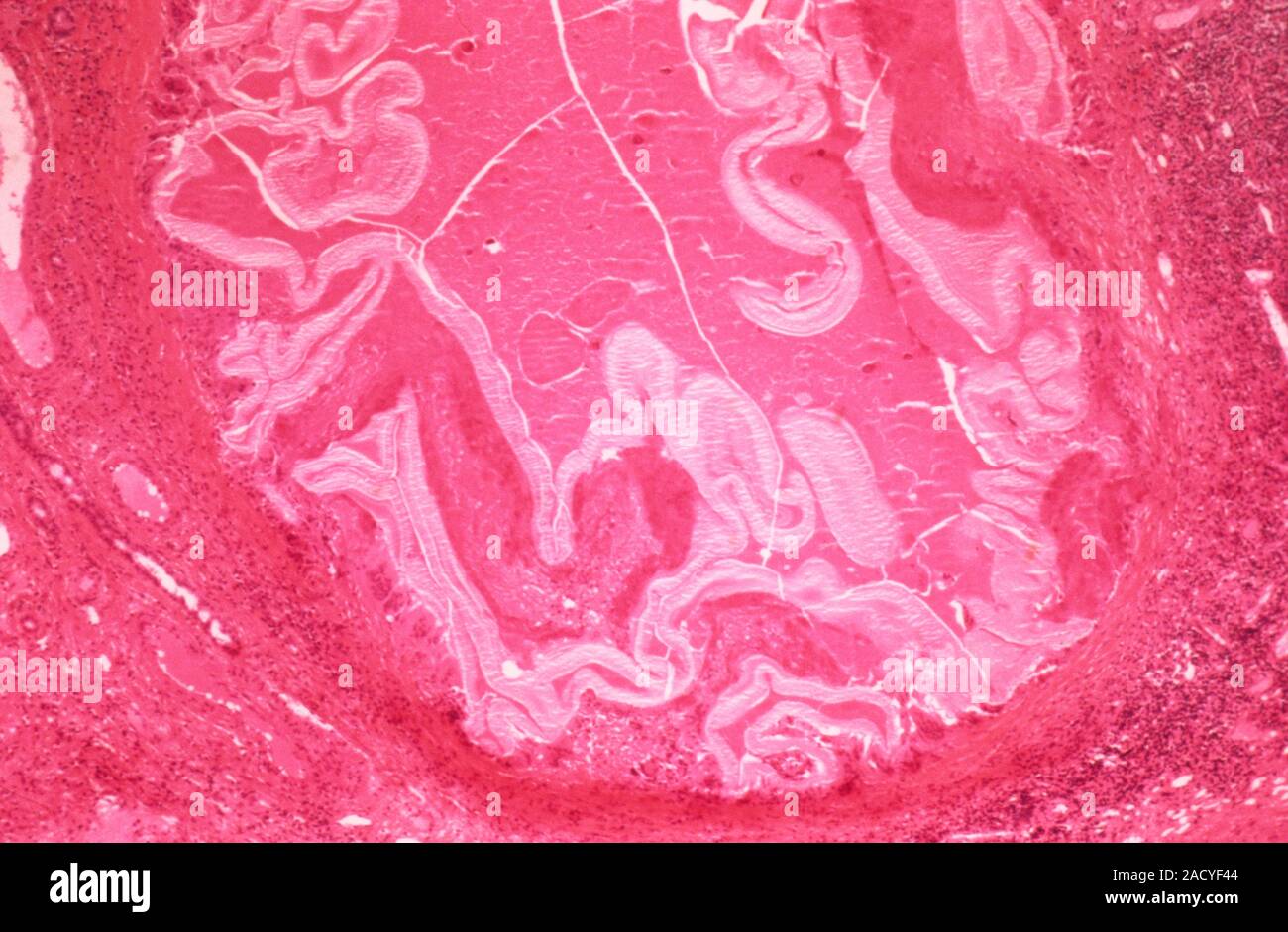 Tapeworm infested liver. Light micrograph of a section through cysts in ...