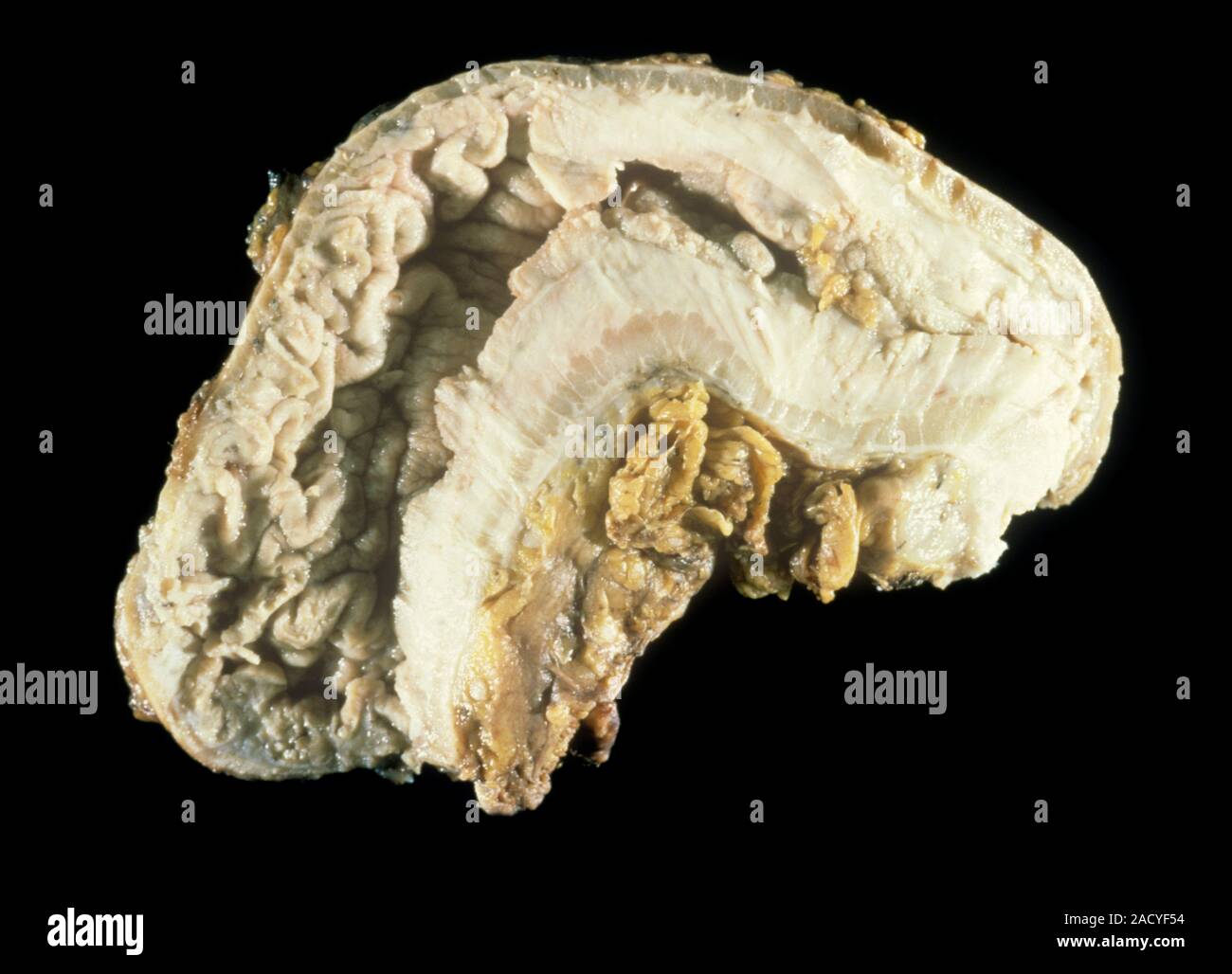 Stomach cancer. Section through a stomach affected by linitis plastica ...