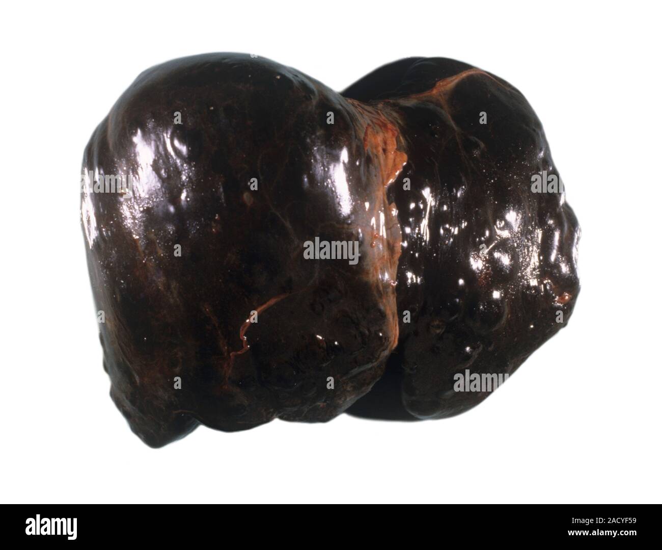 Secondary liver cancer. Liver affected by cancer that has spread ...