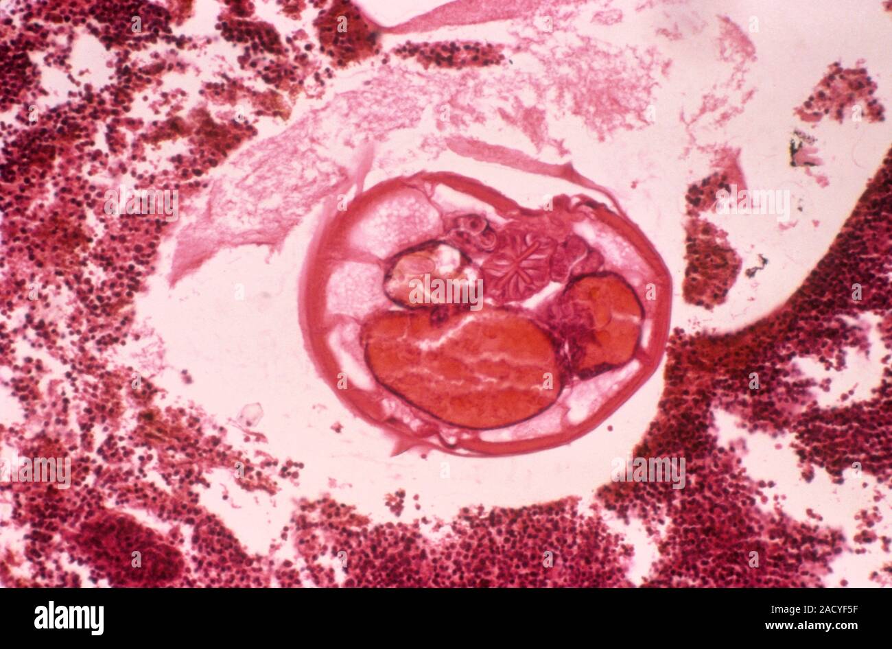 Pinworm infection of the appendix. Light micrograph of a section ...