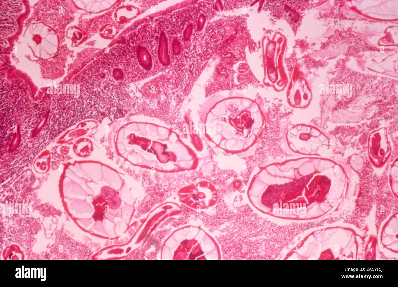 Pinworm infection of the appendix. Light micrograph of a section ...