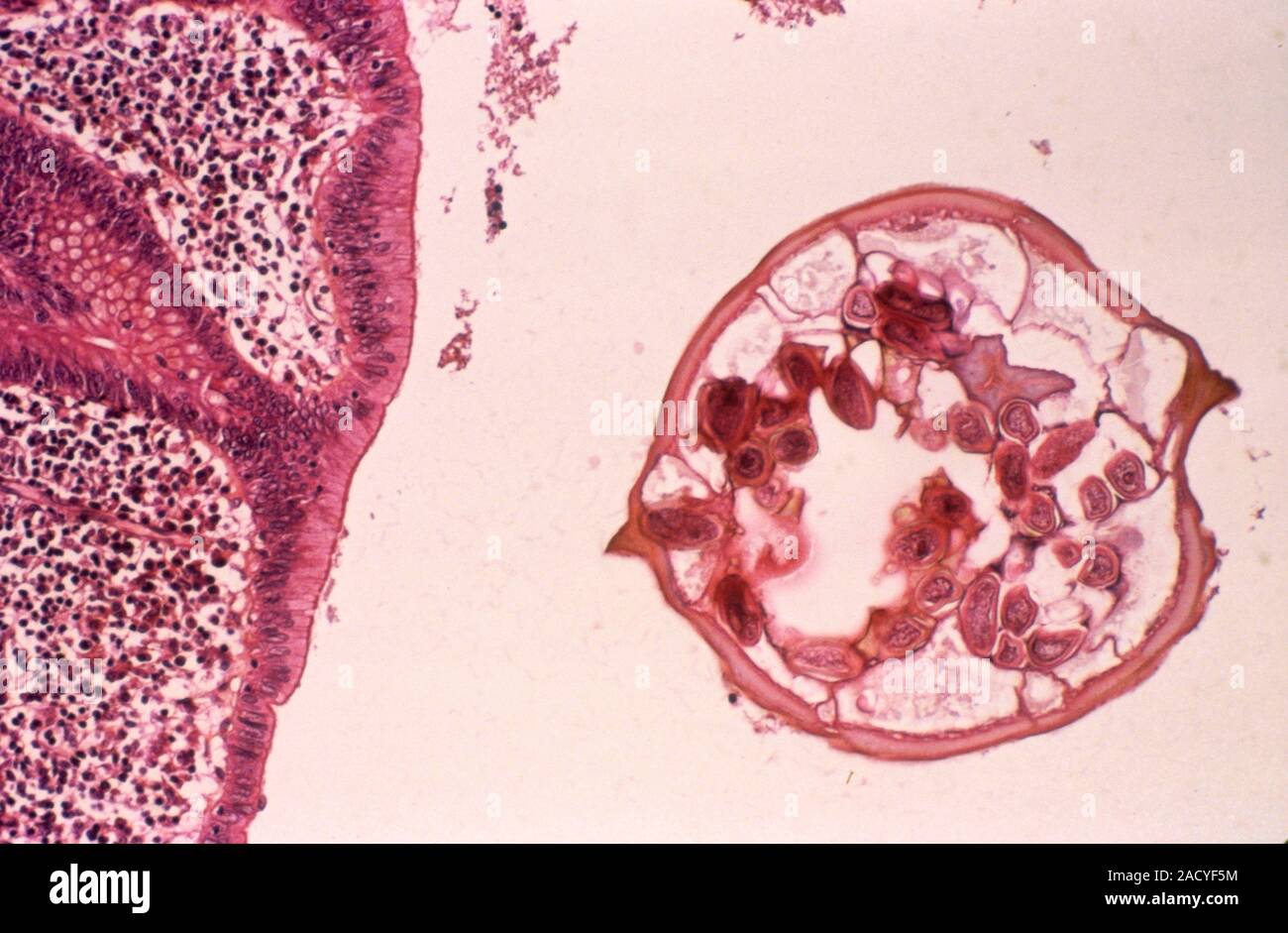 Pinworm infection of the appendix. Light micrograph of a section ...