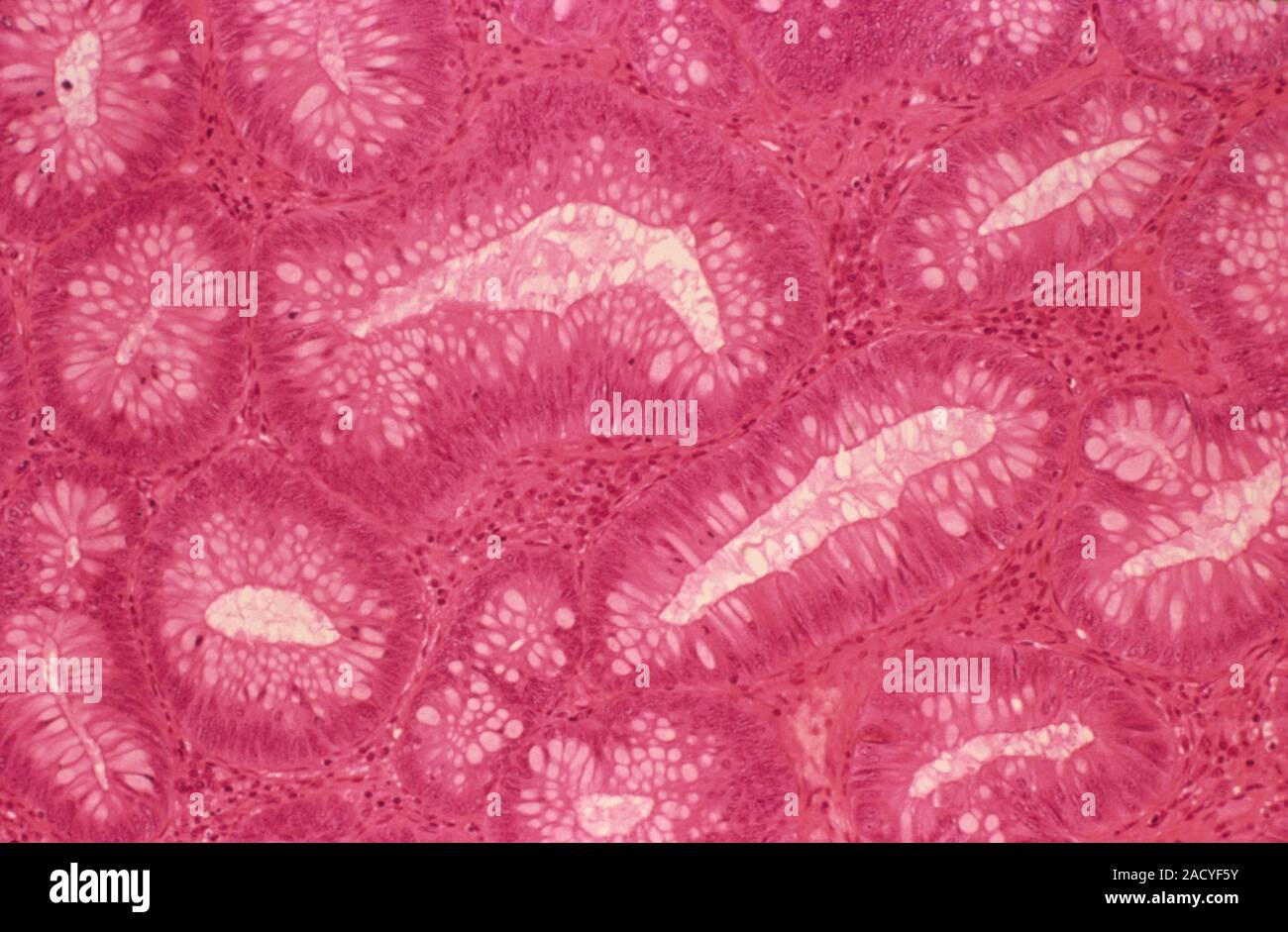 Intestinal polyp. Light micrograph of a section through an adenoma in ...