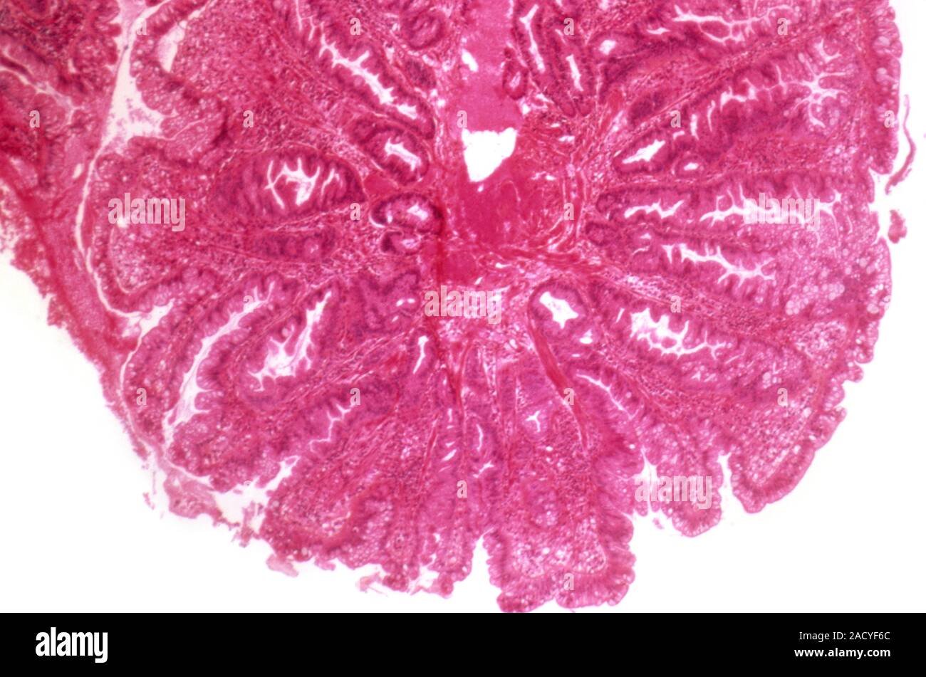Ulcerative colitis. Light micrograph of a section through a colon ...