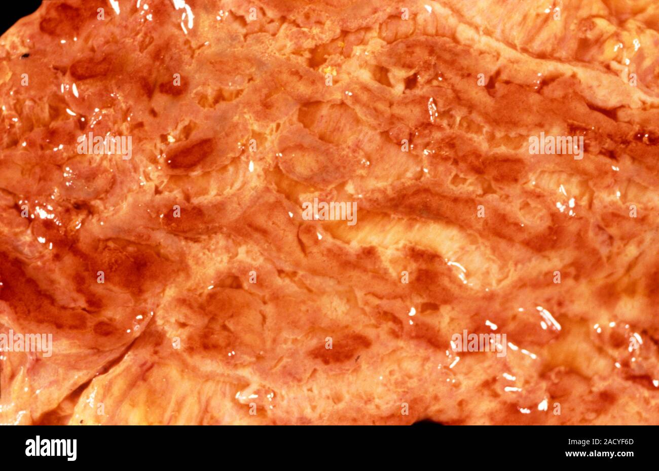 Ulcerative colitis. Close-up of the ulcerated surface of a rectum ...