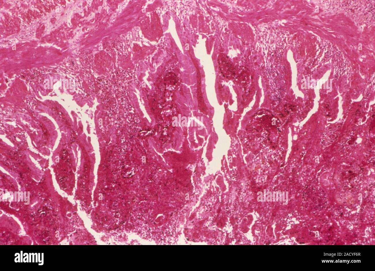 Inflamed gallbladder. Light micrograph of a section through a ...