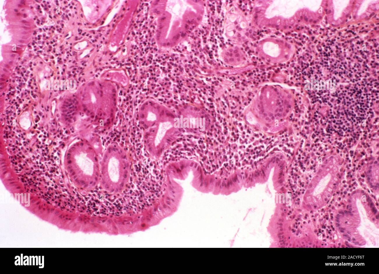 Inflamed gallbladder. Light micrograph of a section through a ...