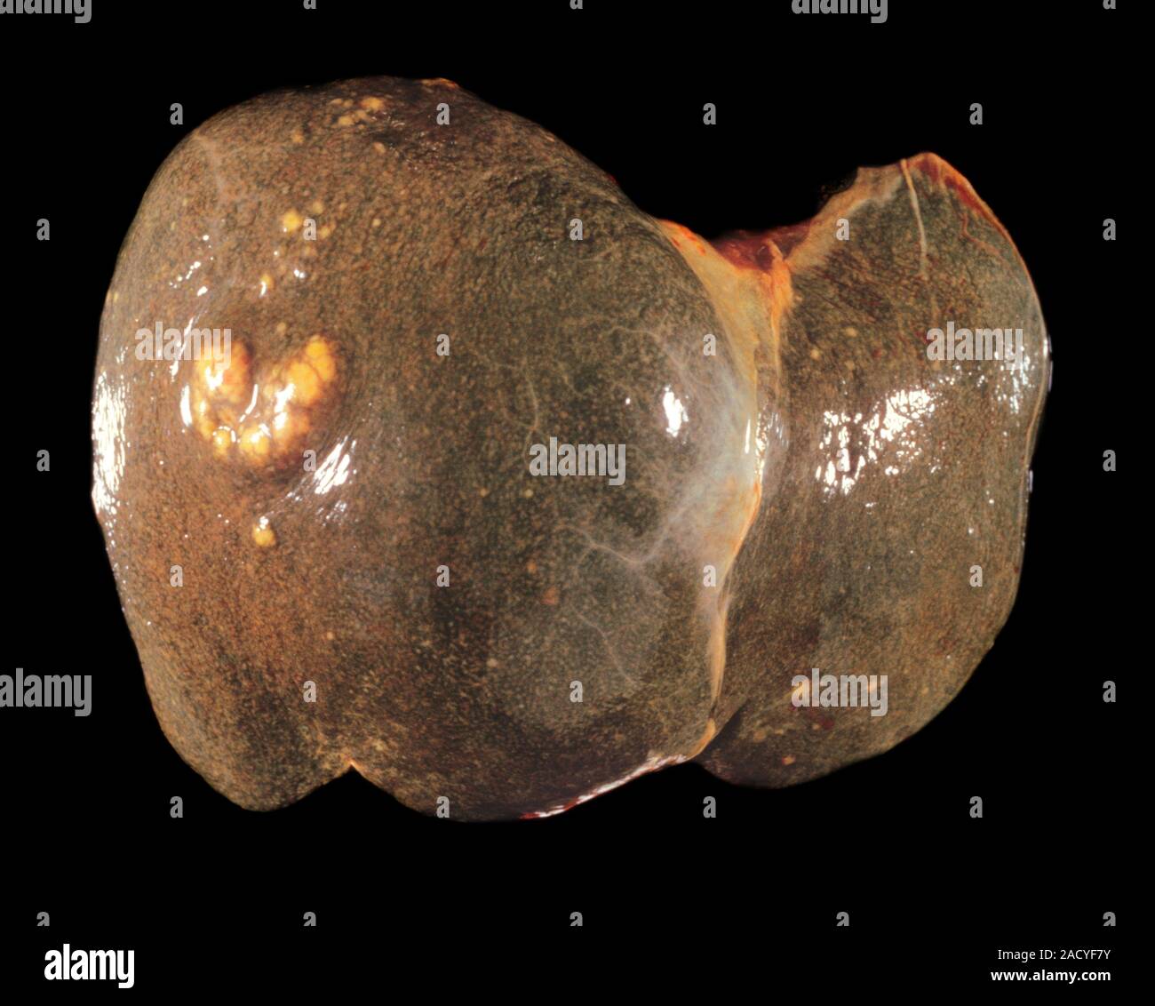 Liver in obstructive jaundice. Liver where an obstruction has caused an ...
