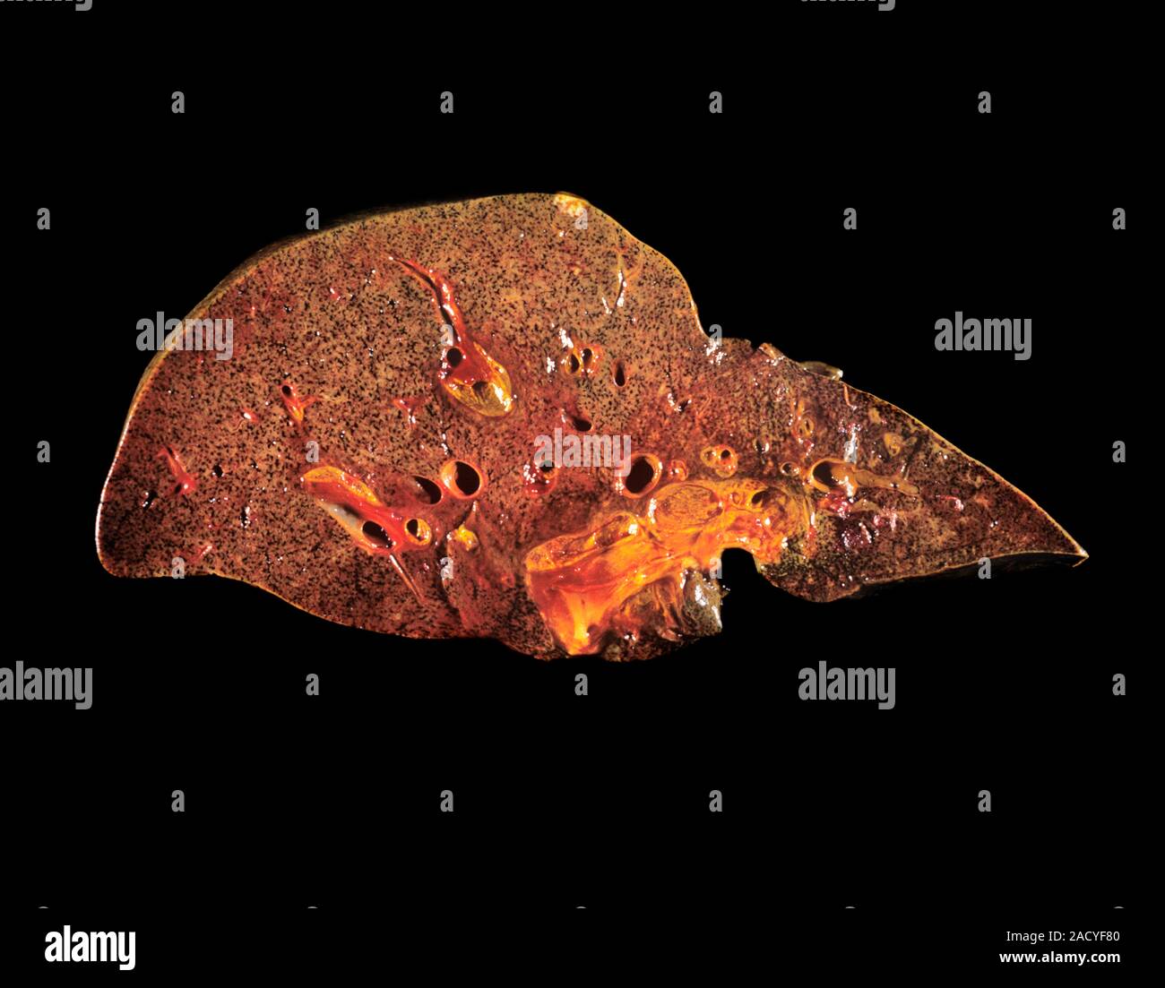 Liver in obstructive jaundice. Section through a liver where an ...