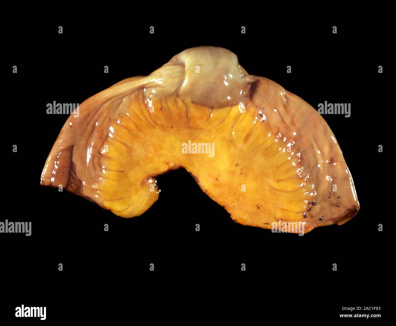 Intussusception of the intestines. intussusception (upper centre) of ...