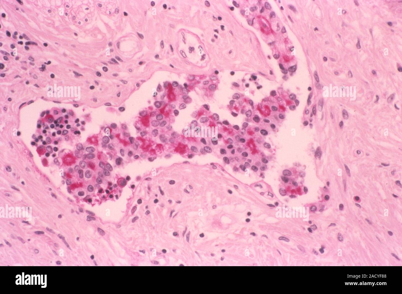 Stomach cancer. Light micrograph of a section through a stomach ...