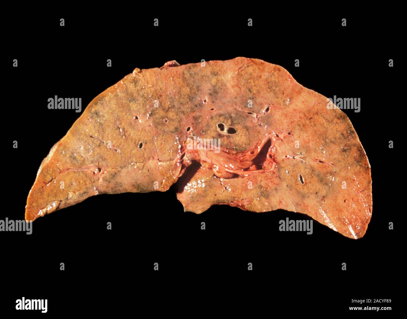 Necrosis of the liver. Section through a liver affected by necrosis ...