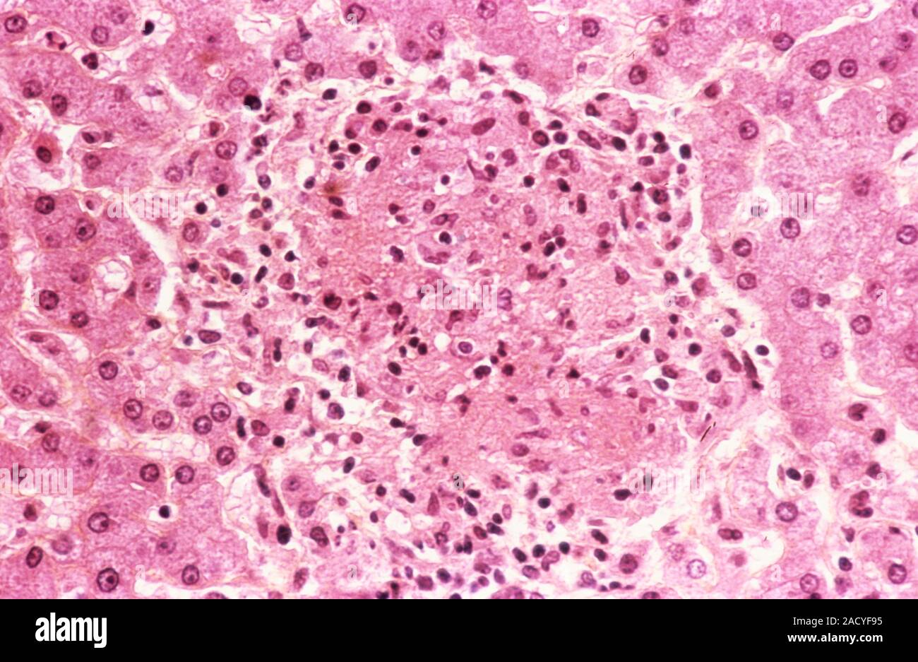 Tuberculosis of the liver. Light micrograph of a section through a ...