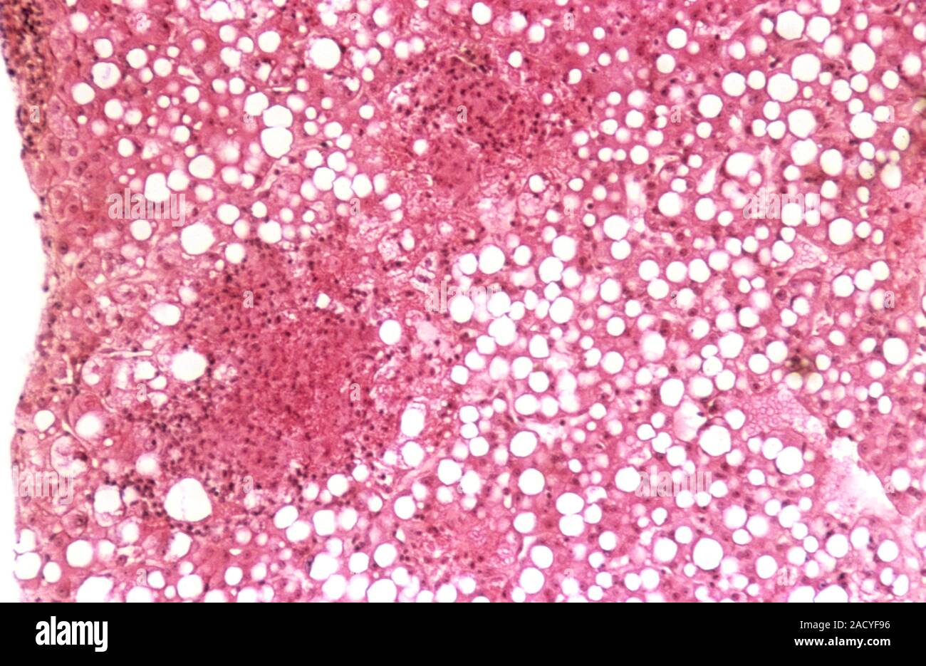 Tuberculosis of the liver. Light micrograph of a section through a ...