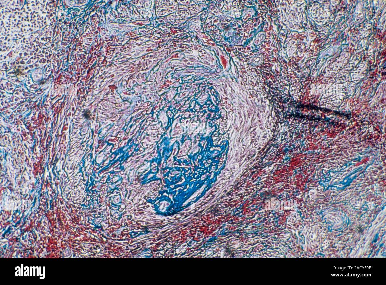 Intestinal cancer. Light micrograph of a section through an sarcoma ...