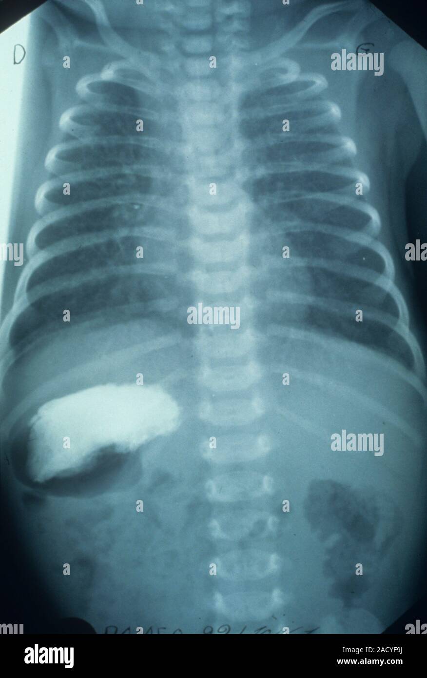 Situs inversus in a child. X-ray of a young child with situs inversus ...