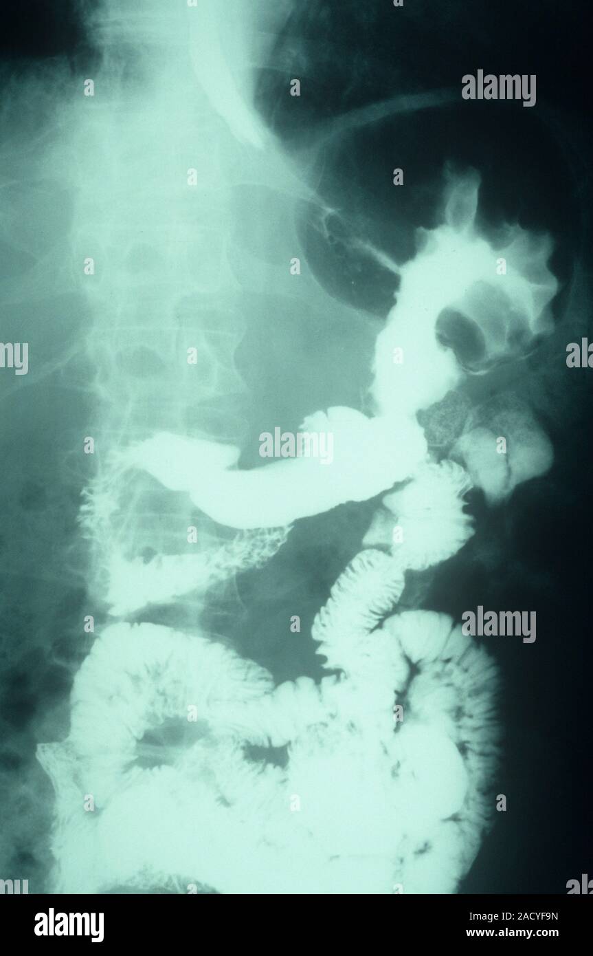 Stomach cancer. Abdominal X-ray of a person with linitis plastica, or ...