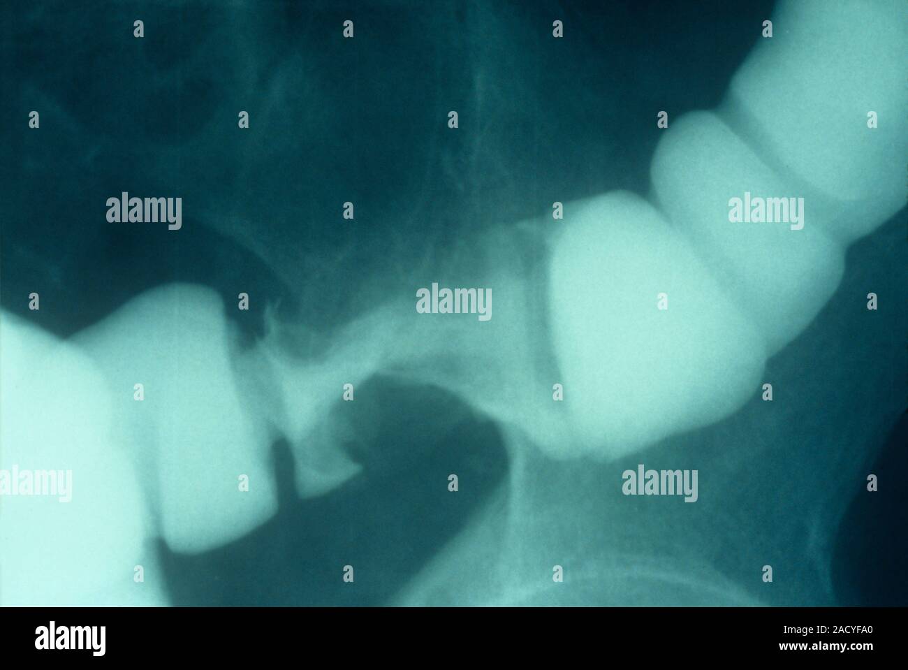 Narrowed colon. Abdominal X-ray showing a stenosed (narrowed) area ...