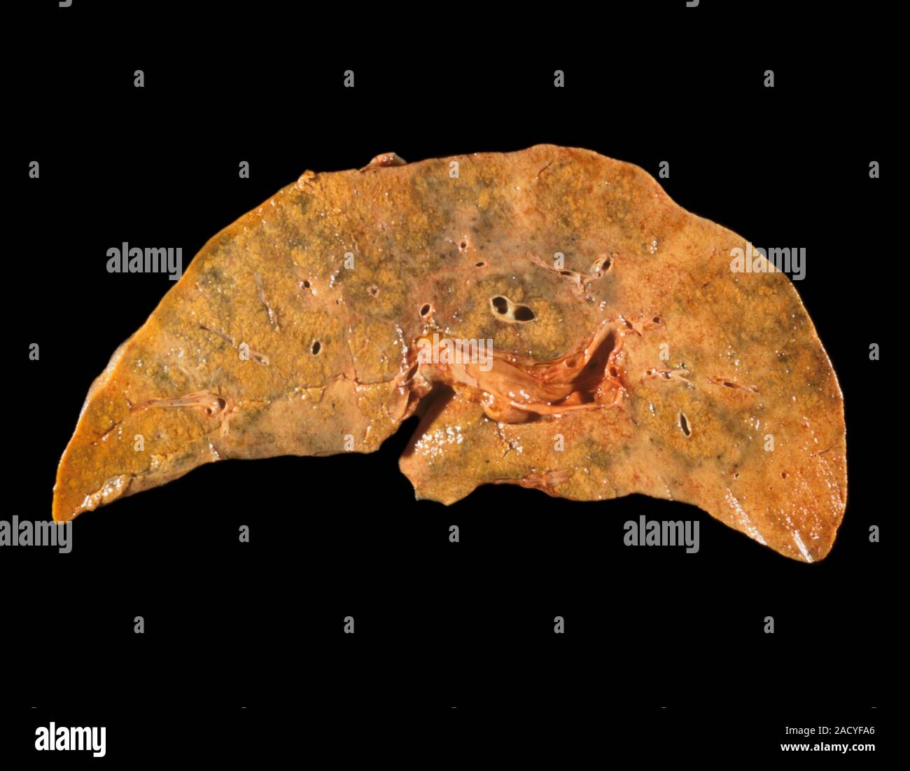 Cirrhotic liver. Section through a liver affected by macronodular (post ...