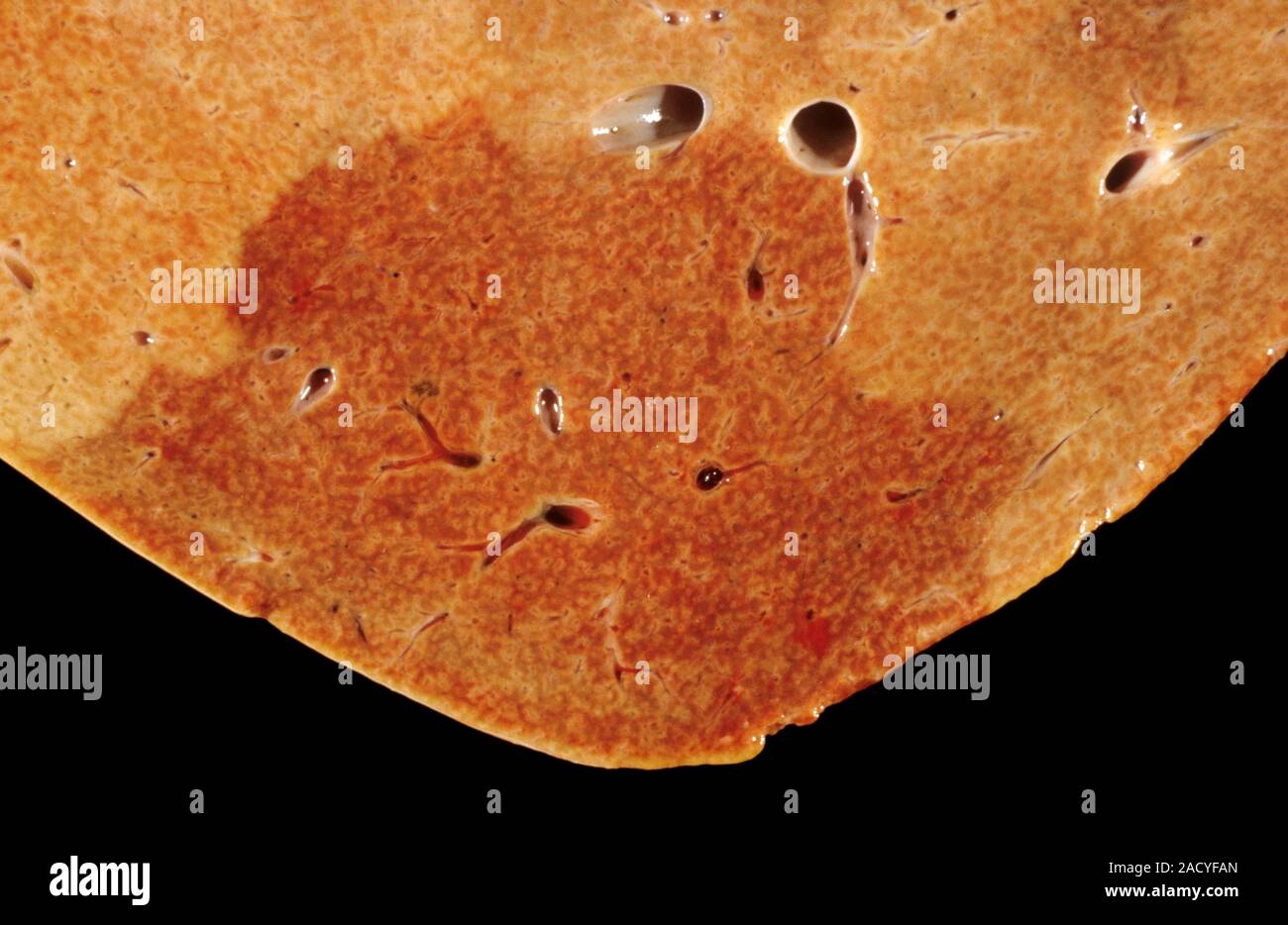 Liver infarction. Close-up of a section through a liver, showing damage ...