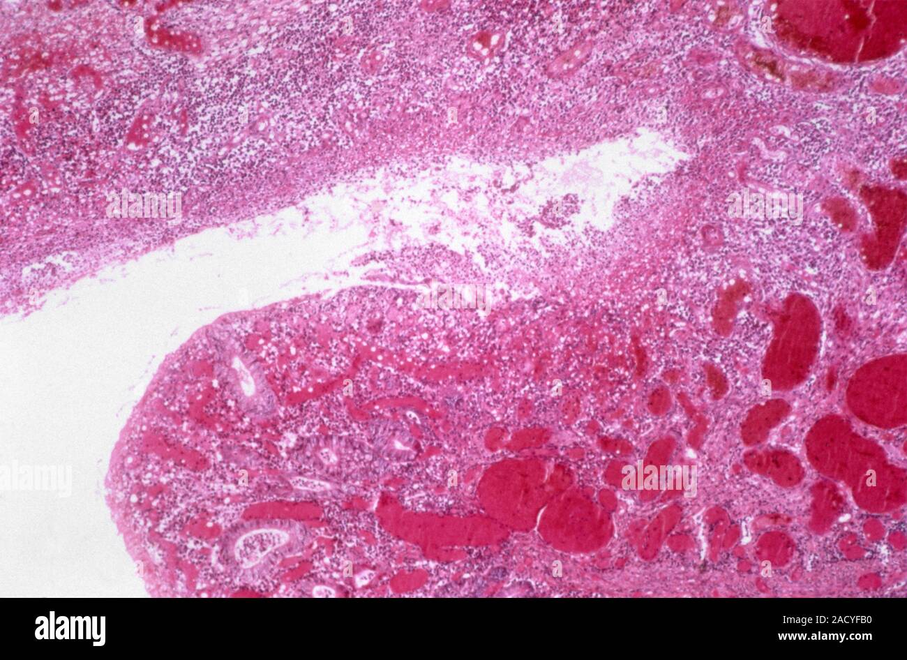 Inflamed colon. Light micrograph of a section through a colon (large ...