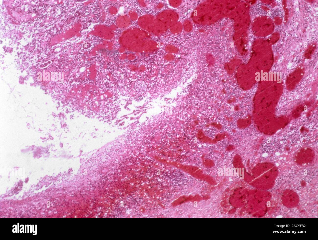 Inflamed colon. Light micrograph of a section through a colon (large ...