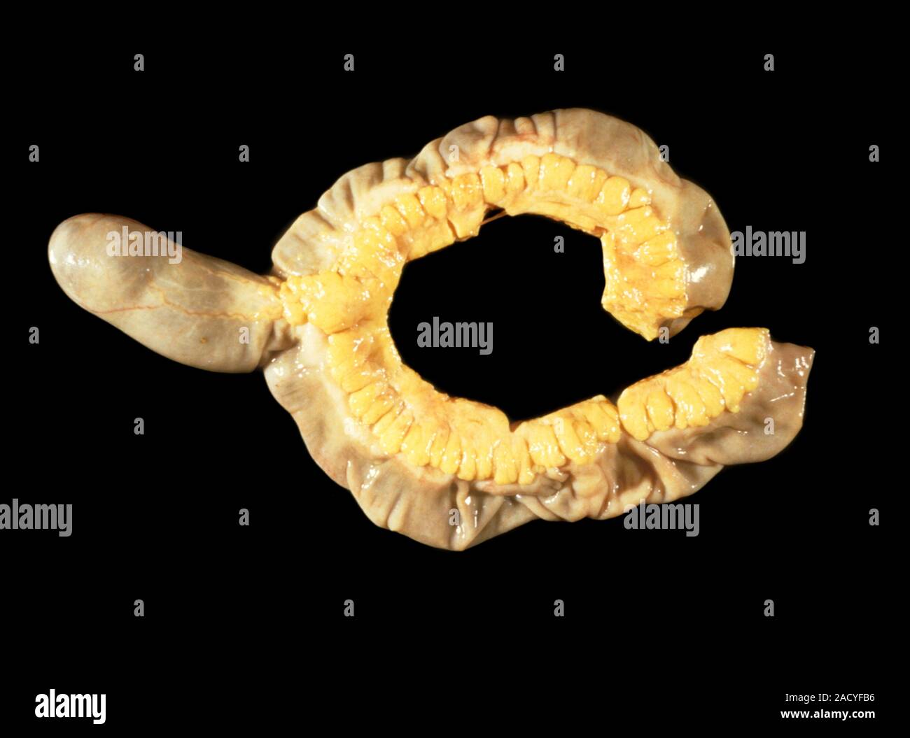 Meckel's diverticulum. Small intestine affected by Meckel's ...