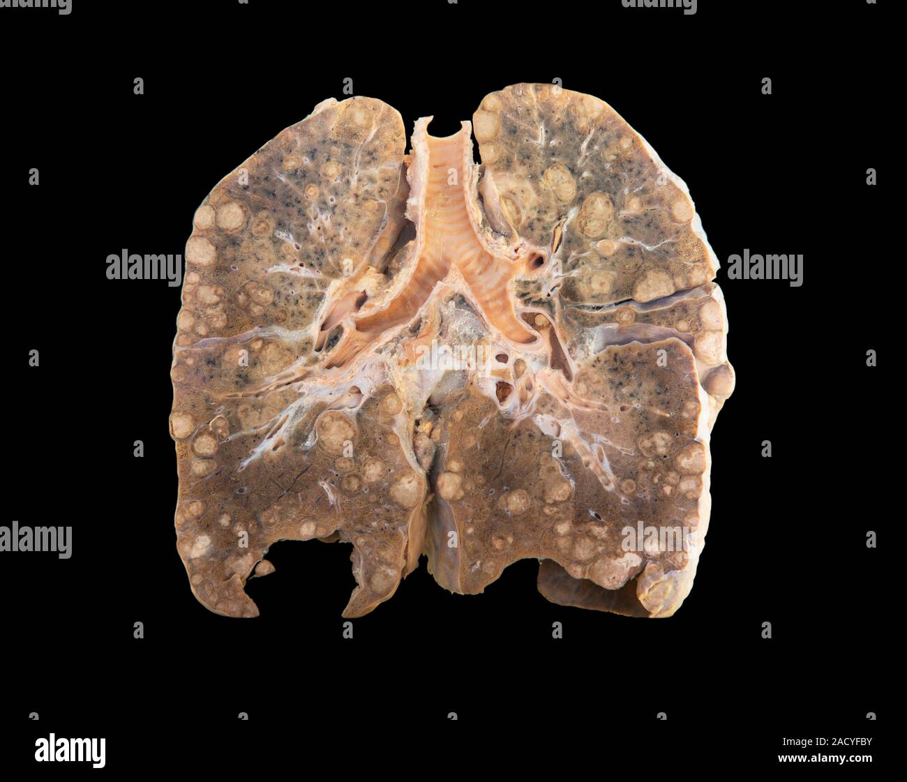 Secondary lung cancer. Clinical post-mortem specimen of human lungs ...