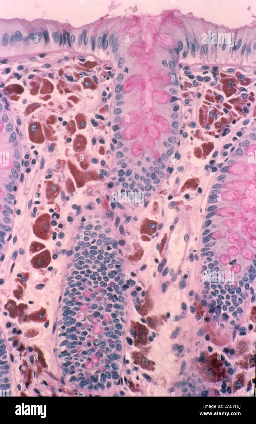 Melanosis coli. Light micrograph of a section through the colon (large ...