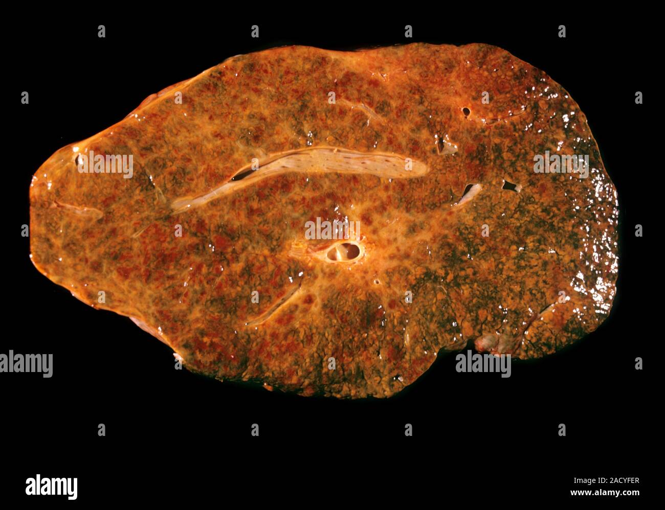 Cirrhosis Of The Liver Section Through A Gross Specimen Of A Liver With Cirrhosis The Normal