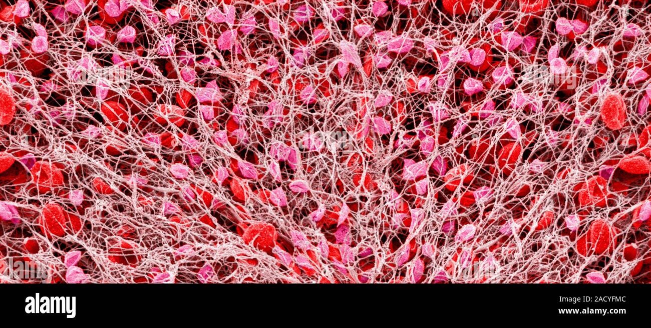 Blood clot, coloured scanning electron micrograph (SEM). Red blood ...