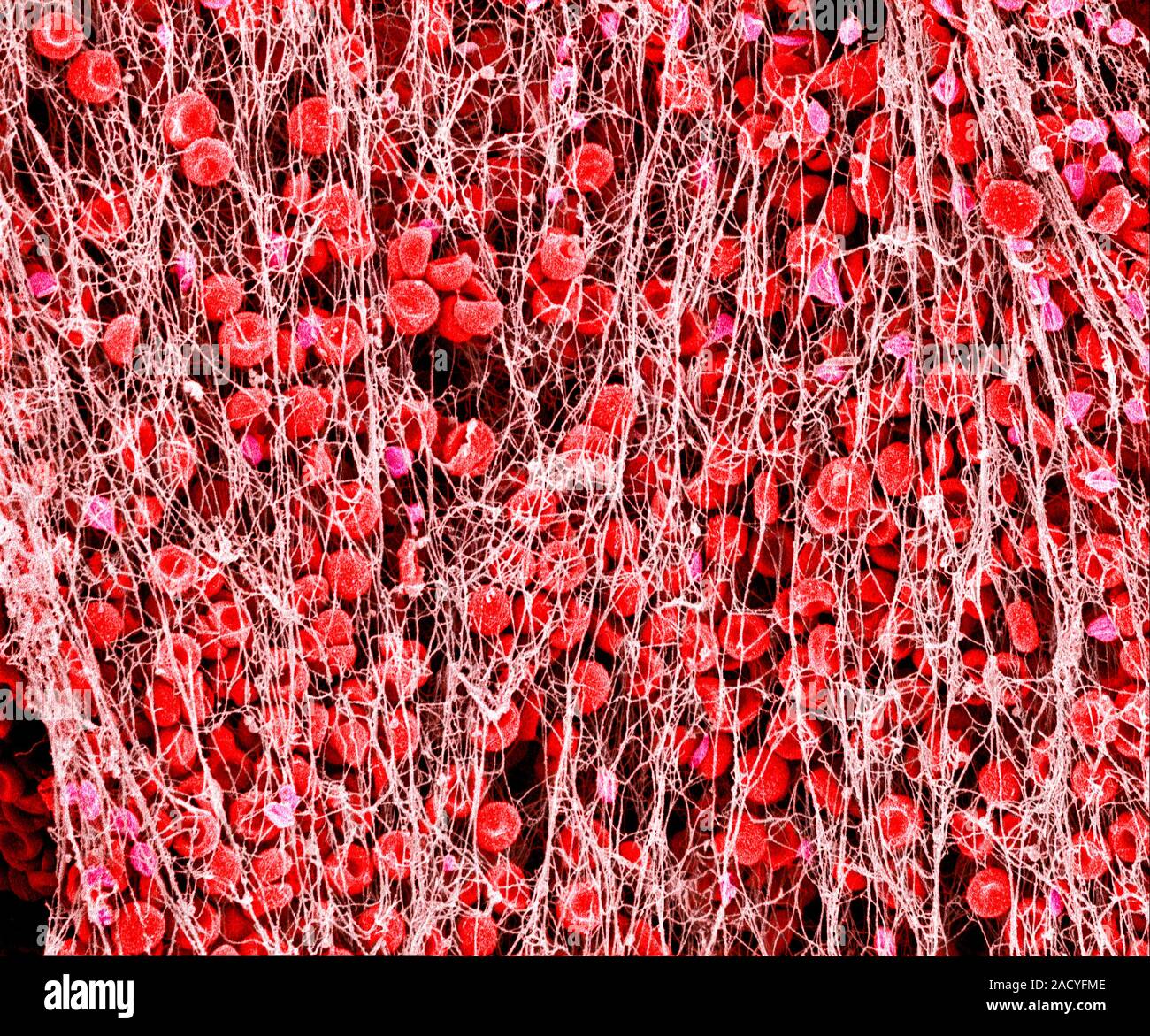 Blood clot, coloured scanning electron micrograph (SEM). Red blood ...