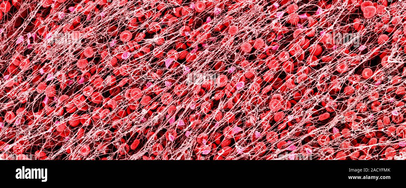 Blood clot, coloured scanning electron micrograph (SEM). Red blood ...