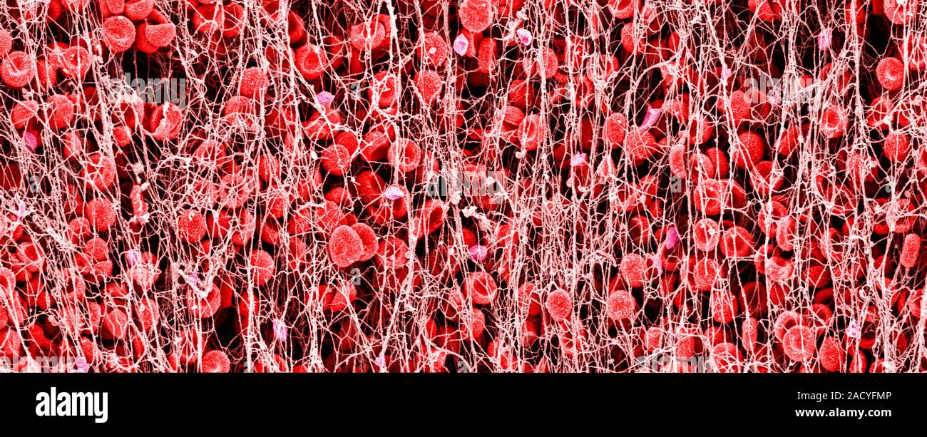 Blood clot, coloured scanning electron micrograph (SEM). Red blood ...