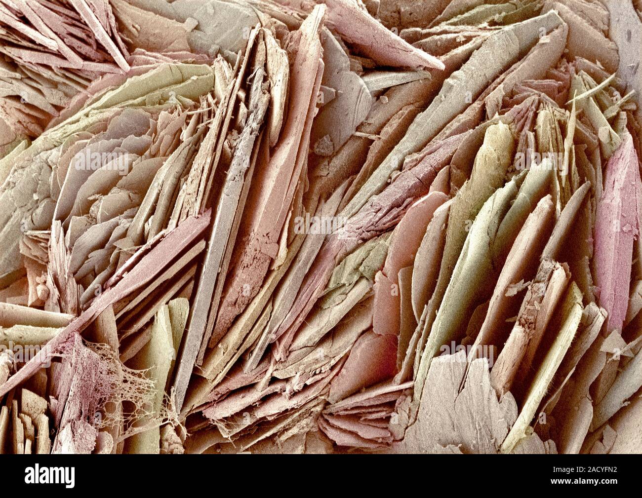 Kidney stone. Coloured scanning electron micrograph (SEM) of the ...