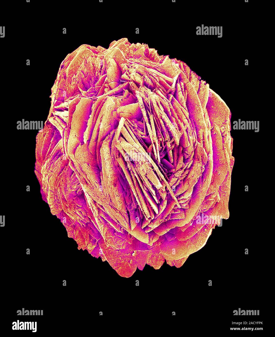 Kidney stone, coloured scanning electron micrograph (SEM). Kidney ...