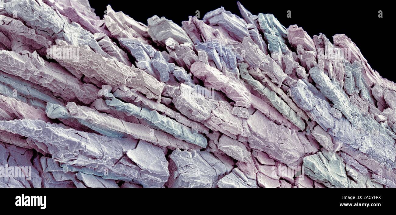 Kidney stone. Coloured scanning electron micrograph (SEM) of the ...