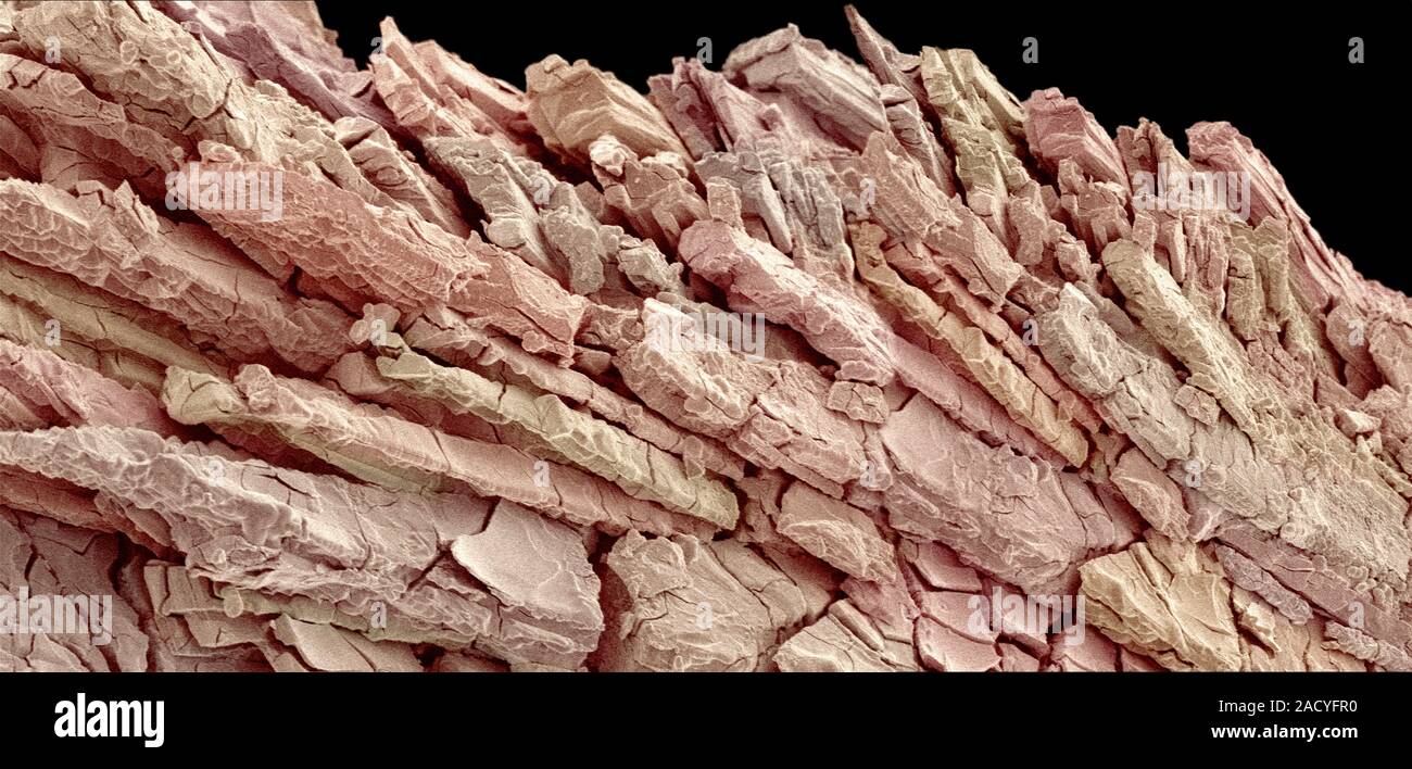 Kidney stone. Coloured scanning electron micrograph (SEM) of the ...