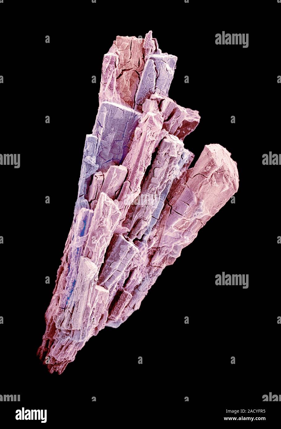Kidney stone. Coloured scanning electron micrograph (SEM) of the ...