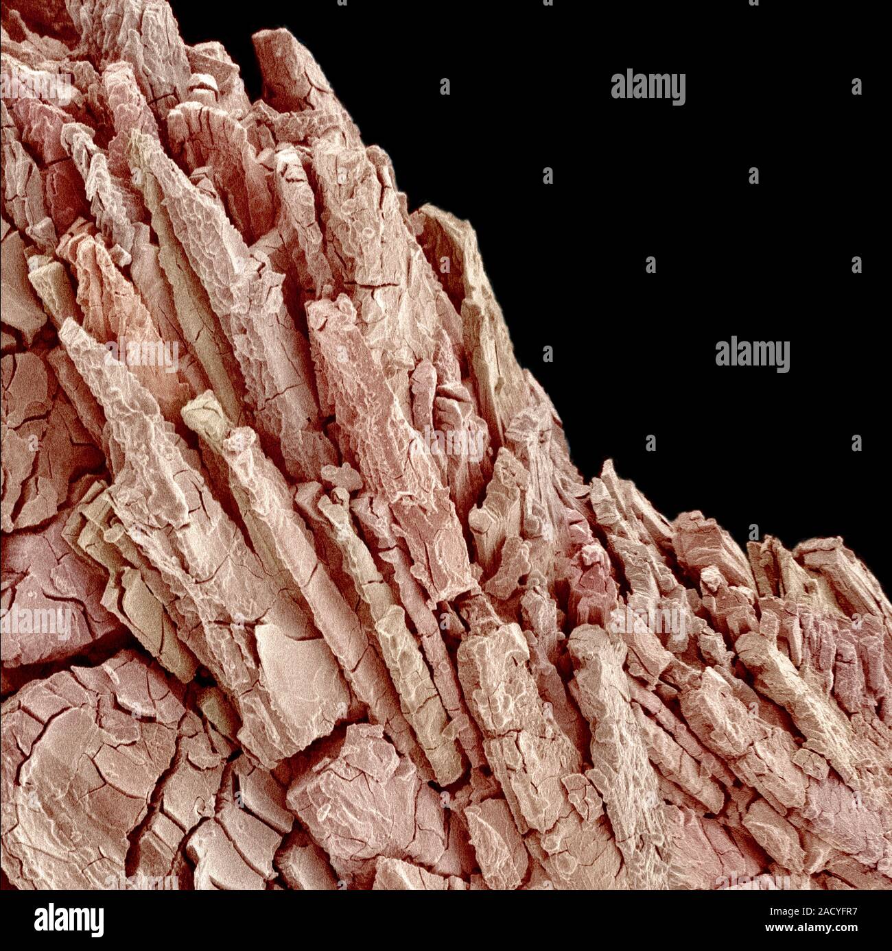 Kidney stone. Coloured scanning electron micrograph (SEM) of the ...