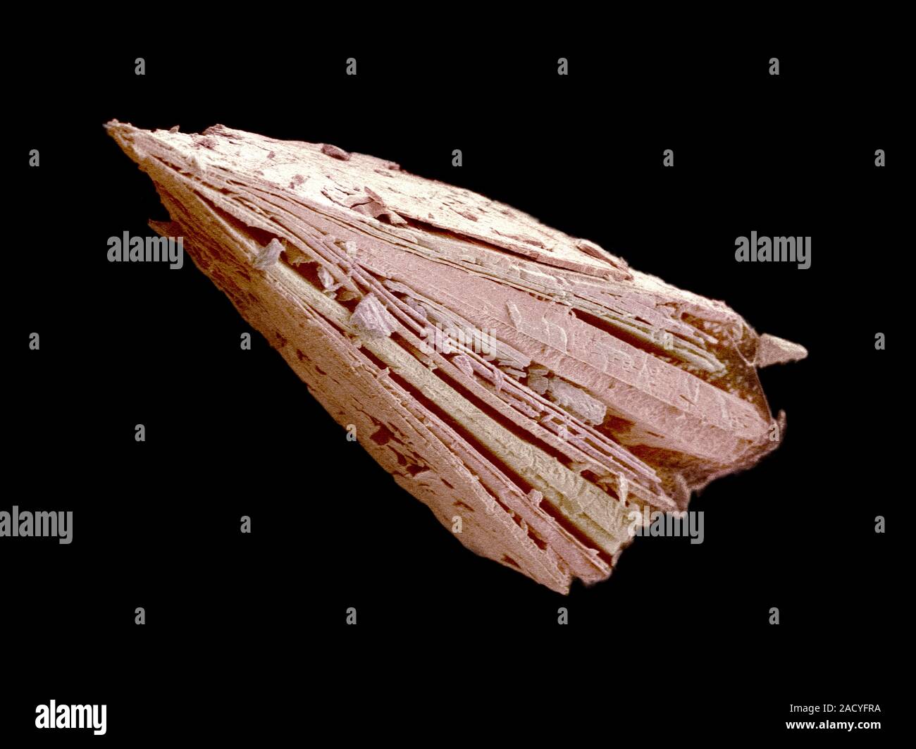 Kidney stone. Coloured scanning electron micrograph (SEM) of the ...