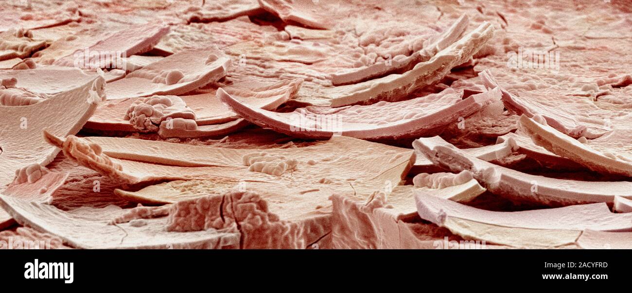 Kidney stone. Coloured scanning electron micrograph (SEM) of the ...