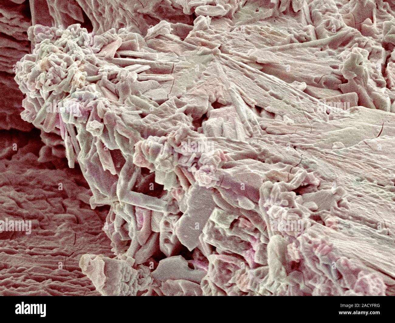 Kidney stone. Coloured scanning electron micrograph (SEM) of the ...