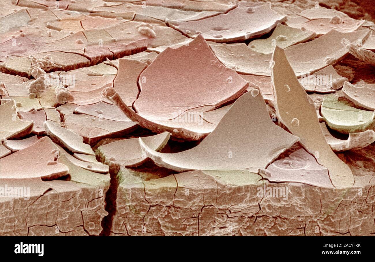 Kidney stone. Coloured scanning electron micrograph (SEM) of the ...