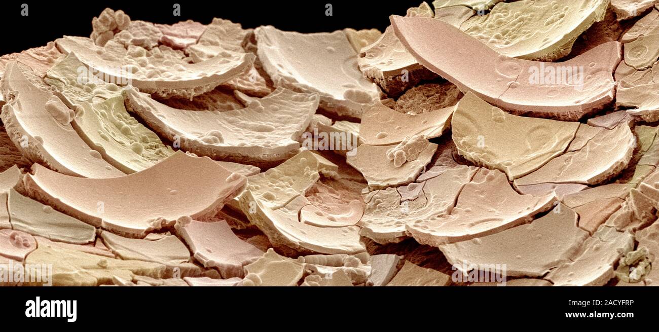 Kidney stone. Coloured scanning electron micrograph (SEM) of the ...