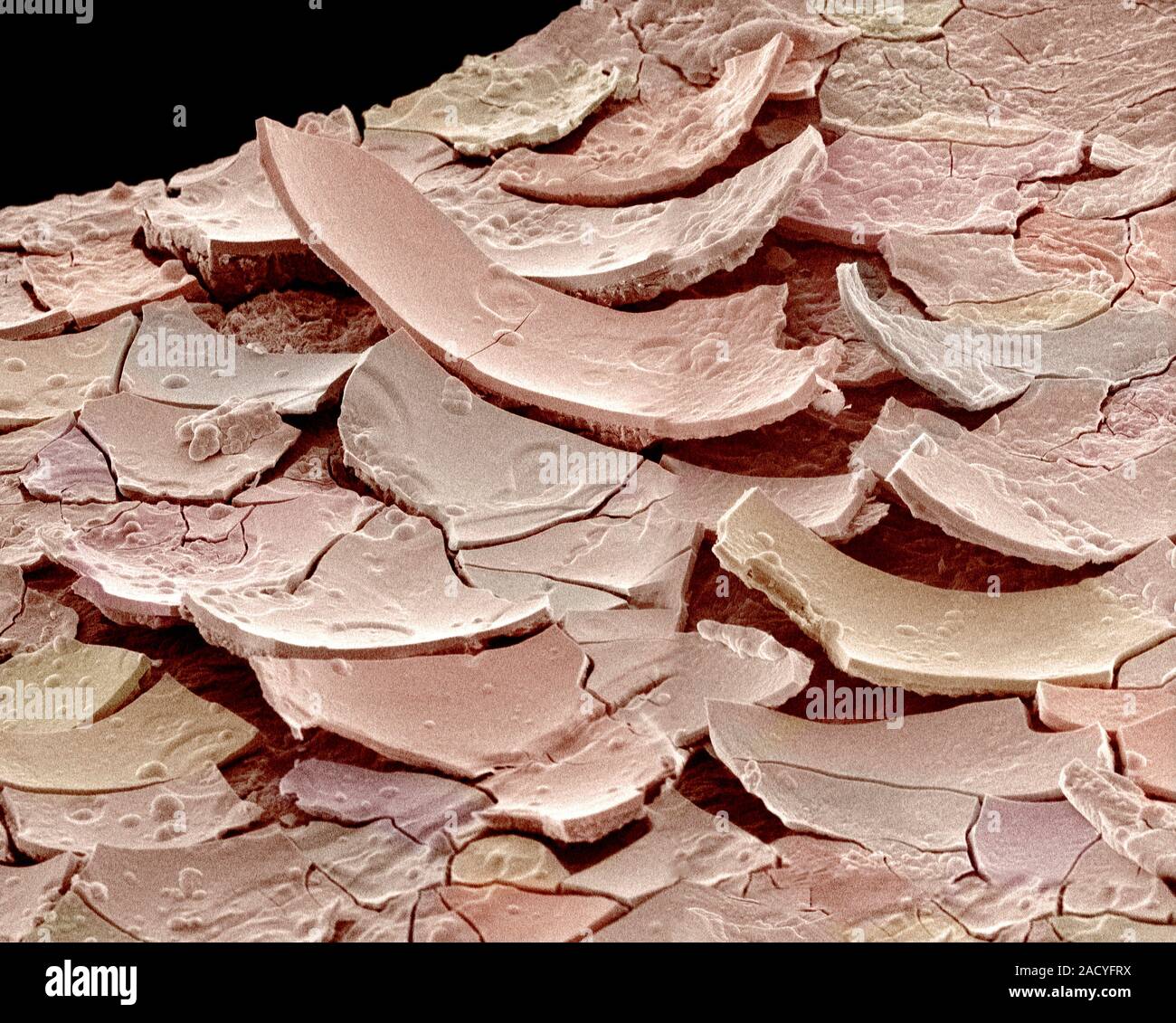 Kidney stone. Coloured scanning electron micrograph (SEM) of the ...