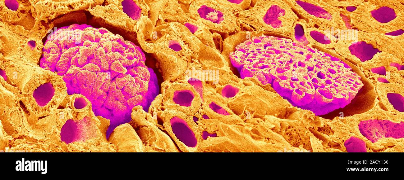 Kidney glomeruli. Coloured scanning electron micrograph (SEM) of two ...