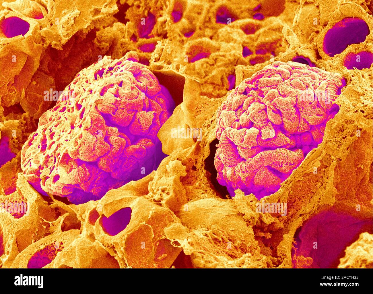 Kidney glomeruli. Coloured scanning electron micrograph (SEM) of two ...