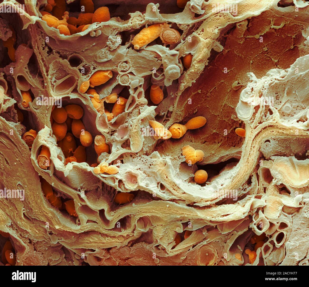 Thrush infection of the tongue. Coloured scanning electron micrograph ...